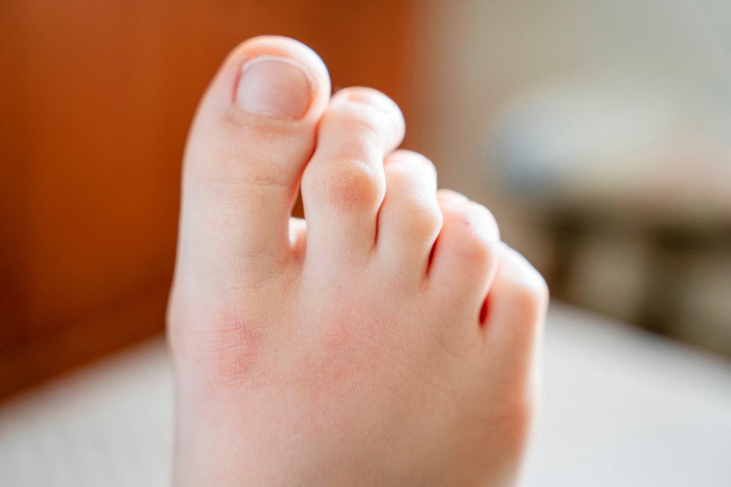 Causas y síntomas del Dedo en Martillo